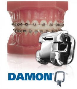 Damon System Braces - Stewart Family Orthodontics