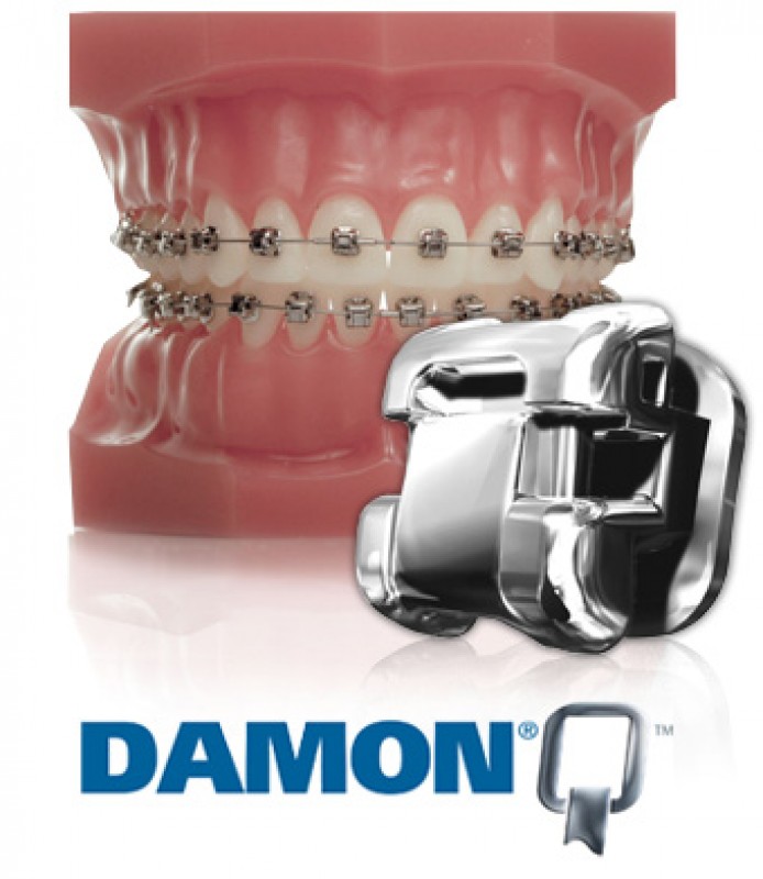 Damon System Braces - Stewart Family Orthodontics
