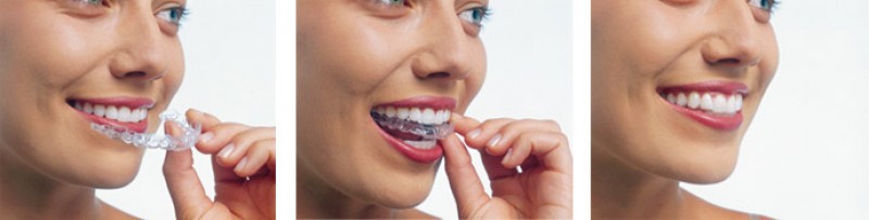 Invisalign at Stewart Family Orthodontics - Weatherford, TX